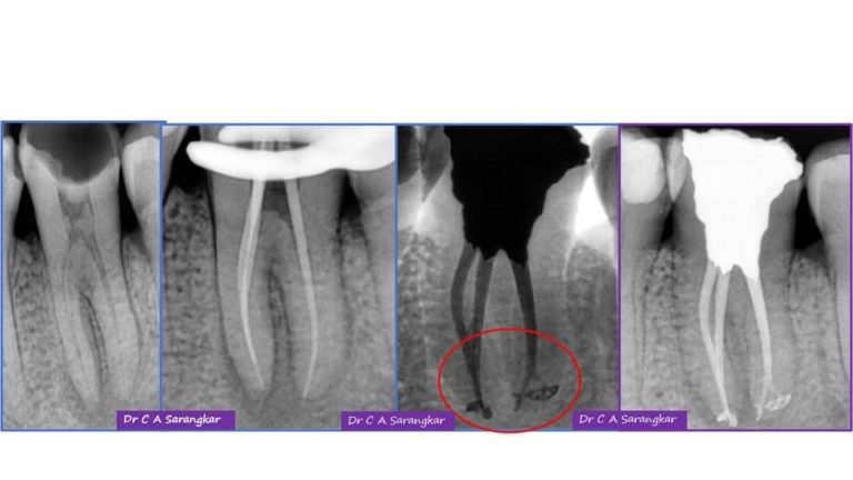 Clinical Considerations in Management of Complex Apical Root Canal ...